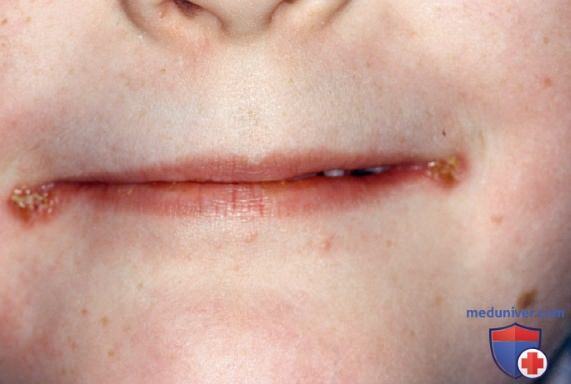 Заболевания слизистых оболочек у детей - кратко с точки зрения педиатрии